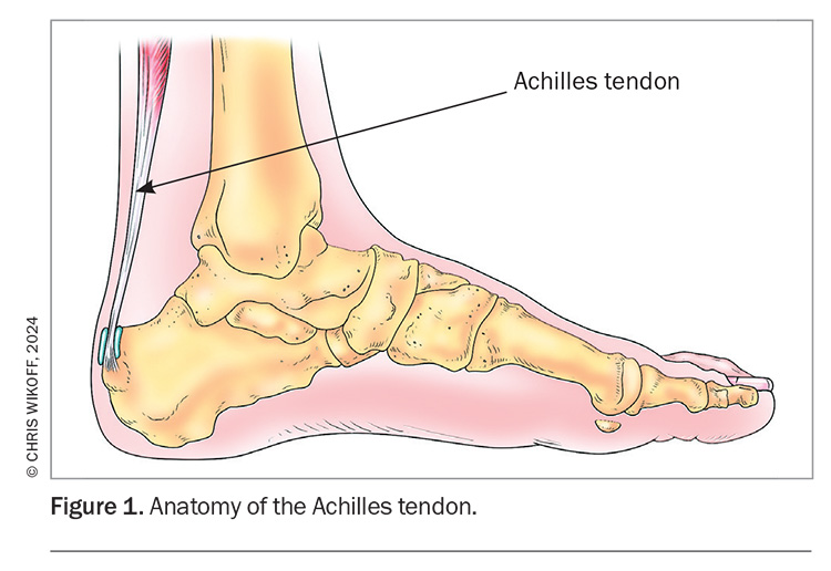 Acute Achilles tendon rupture: diagnosis and management | Medicine Today